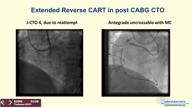Reverse CART techniques: conventional, directed, extended, assisted … | PPT