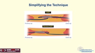 Reverse CART techniques: conventional, directed, extended, assisted … | PPT