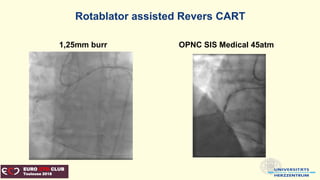 Reverse CART techniques: conventional, directed, extended, assisted … | PPT
