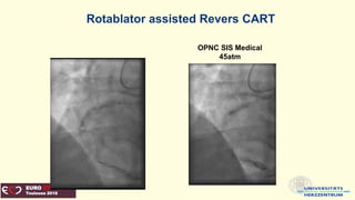 Reverse CART techniques: conventional, directed, extended, assisted … | PPT