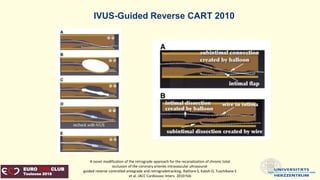 Reverse CART techniques: conventional, directed, extended, assisted … | PPT