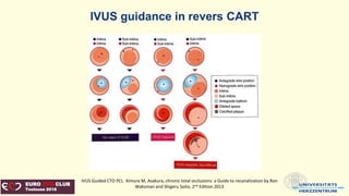 Reverse CART techniques: conventional, directed, extended, assisted … | PPT