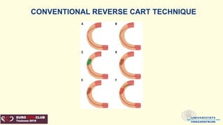 Reverse CART techniques: conventional, directed, extended, assisted … | PPT