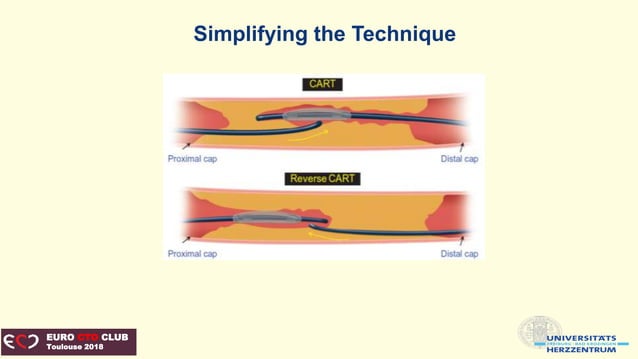 Reverse CART techniques: conventional, directed, extended, assisted