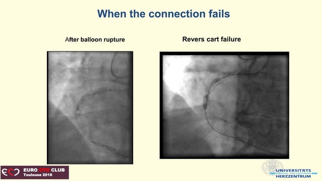 Reverse Cart Techniques Conventional Directed Extended Assisted