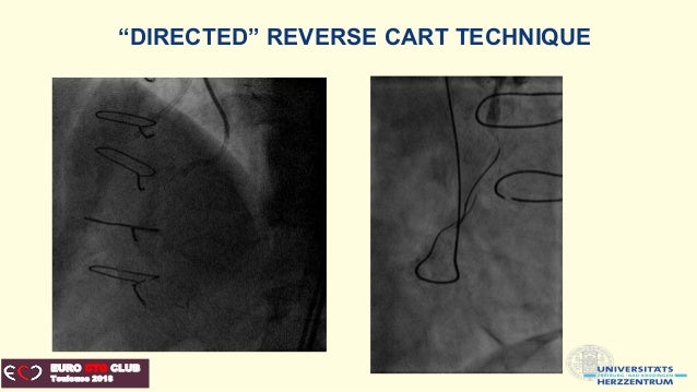 Reverse Cart Techniques Conventional Directed Extended Assisted
