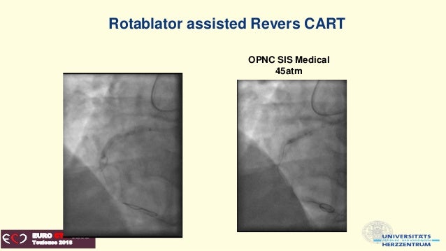 Reverse Cart Techniques Conventional Directed Extended Assisted