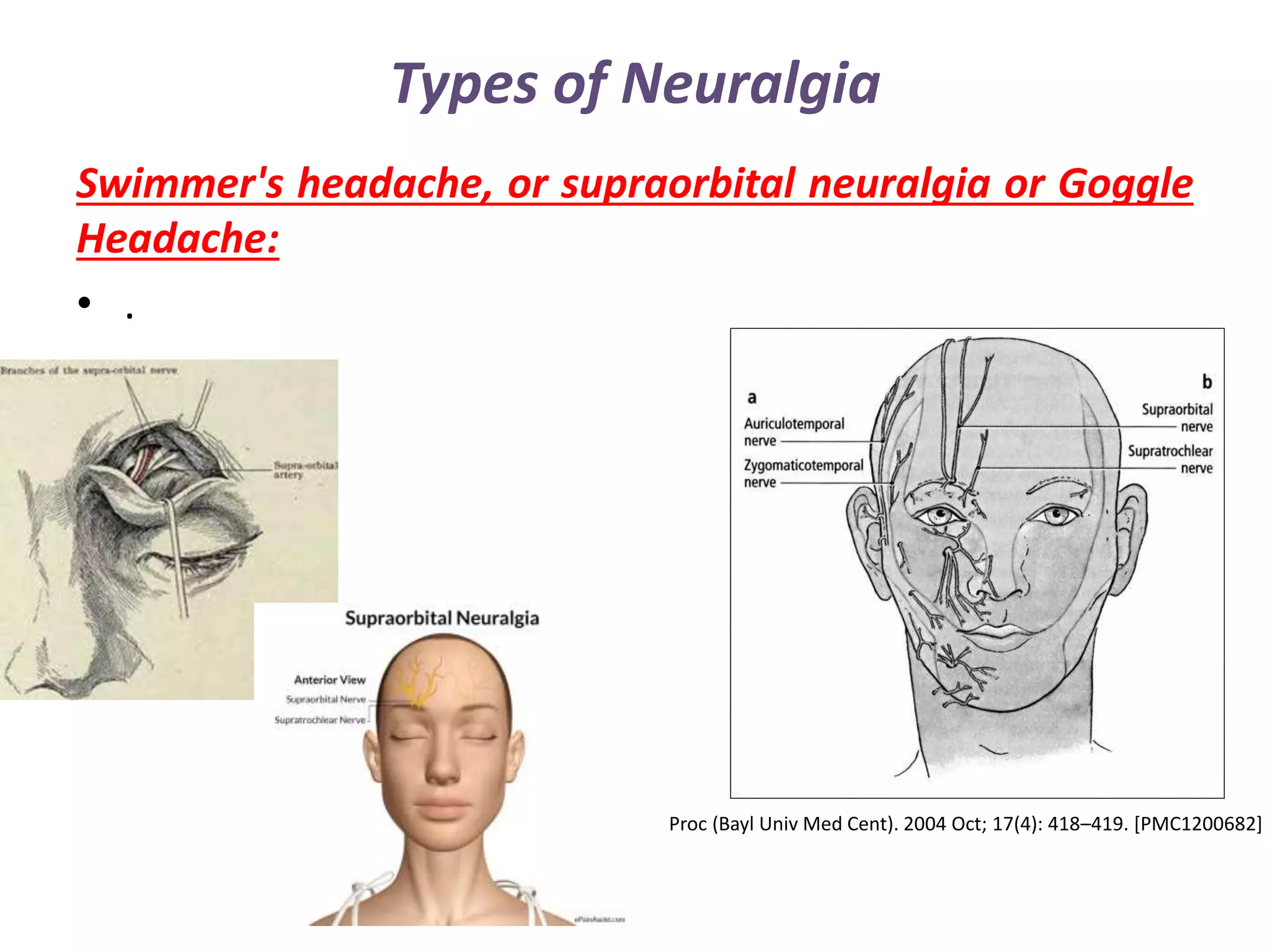 Neuralgia | PPTX