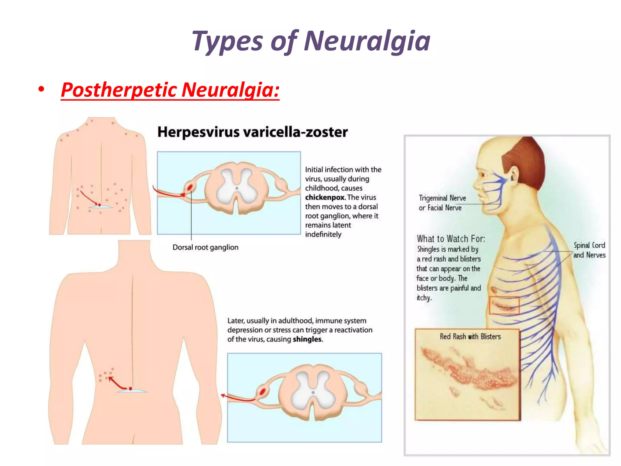 Neuralgia | PPTX