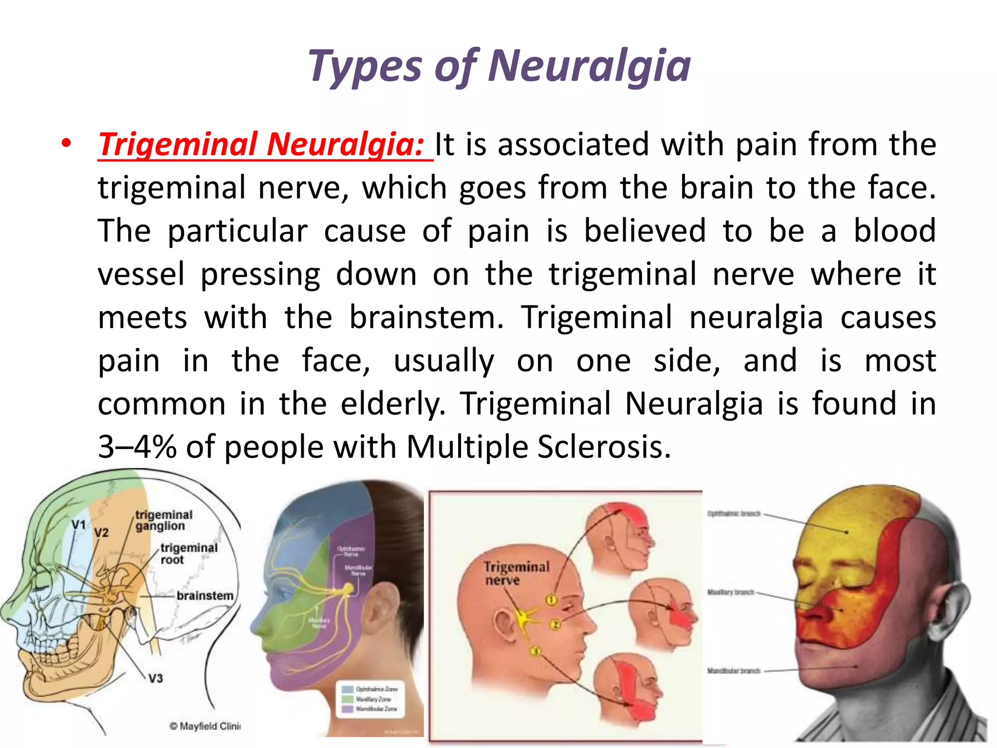 Neuralgia | PPTX