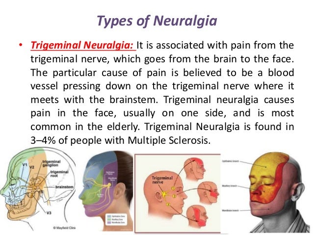 Neuralgia
