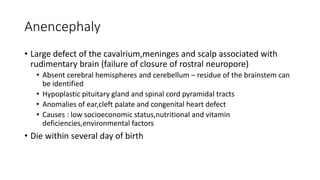 Neural tube defect | PPT