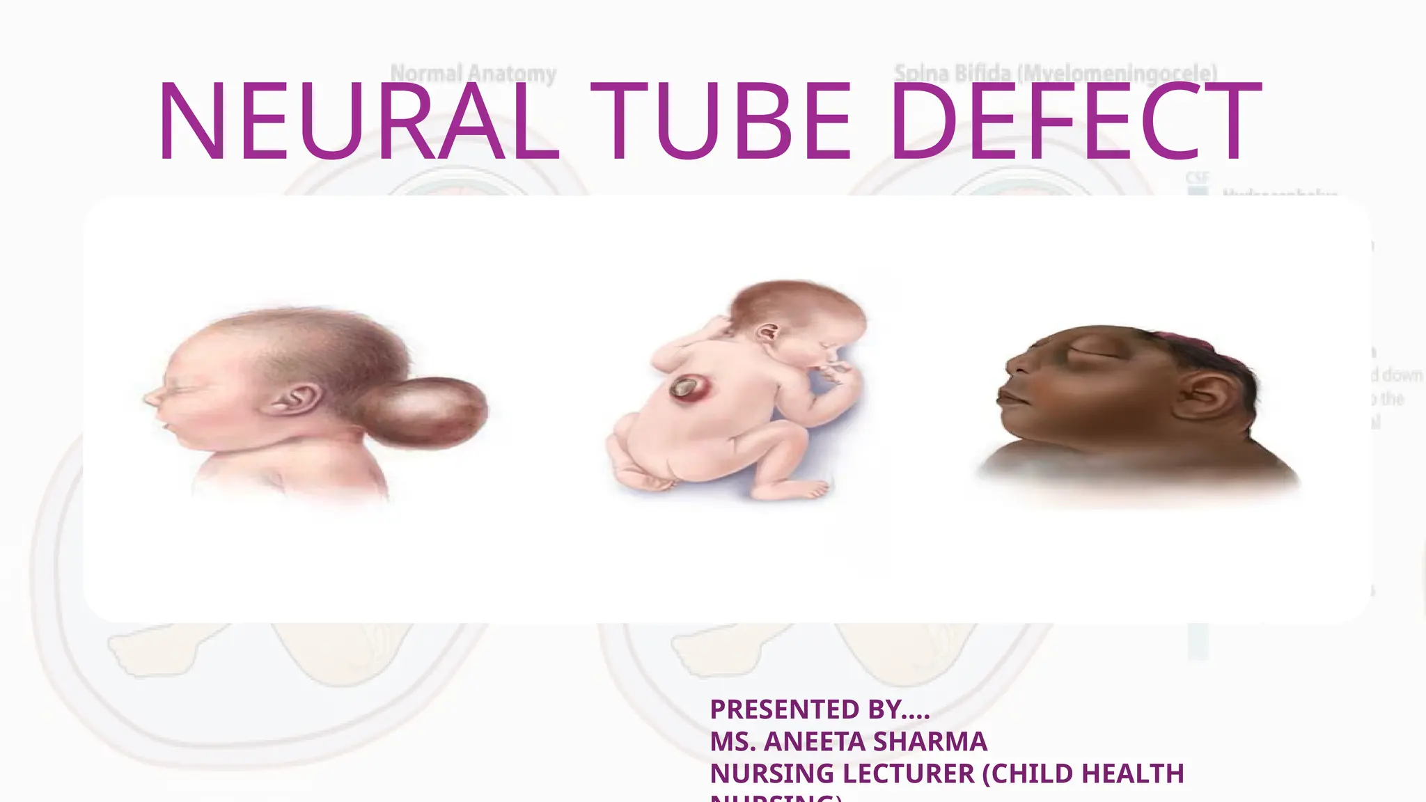 NEURAL TUBE DEFECT pptx | PPTX