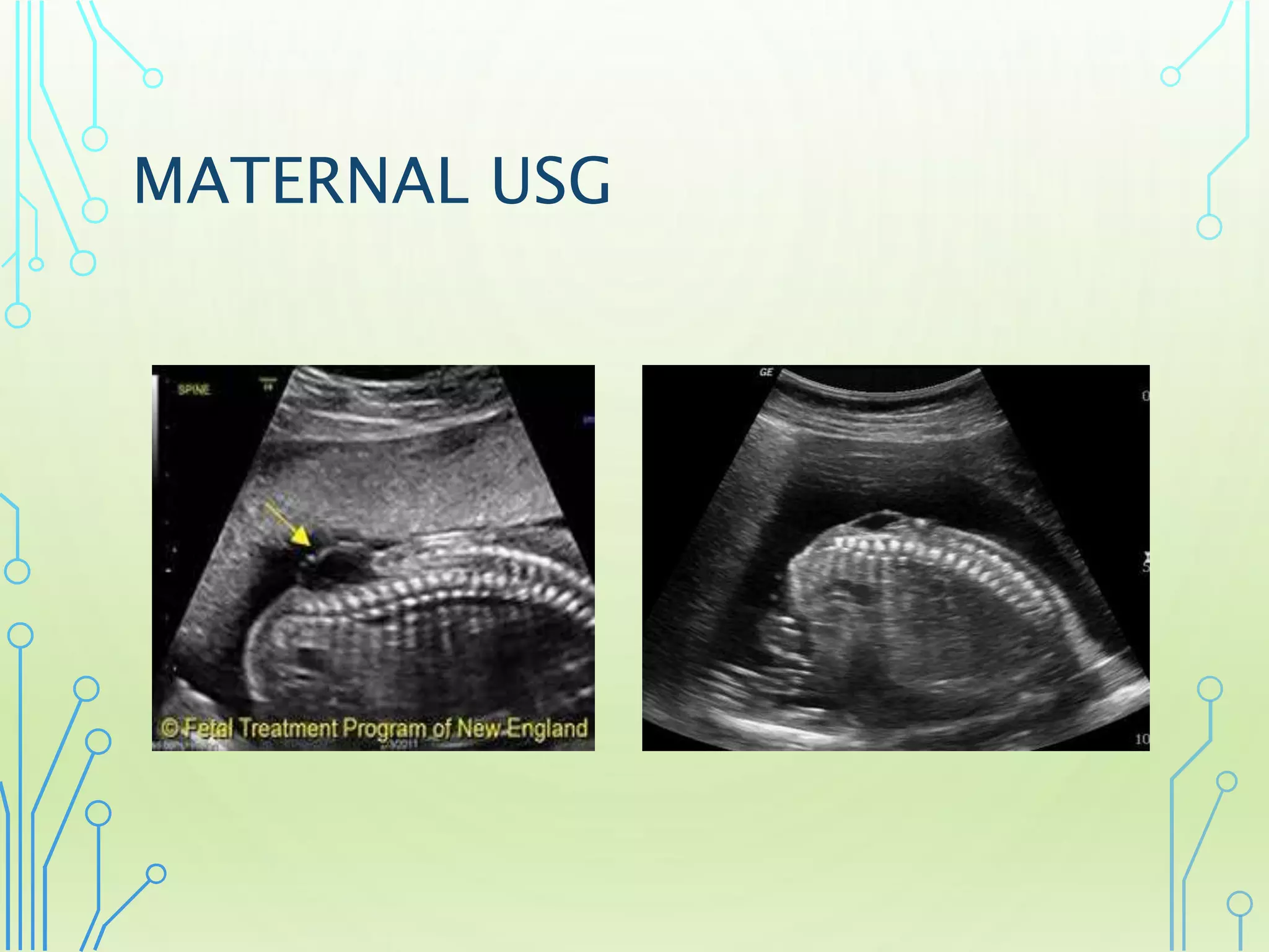 Neural tube defect | PPTX