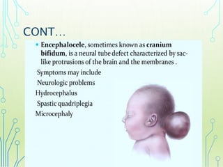 Neural tube defect | PPTX