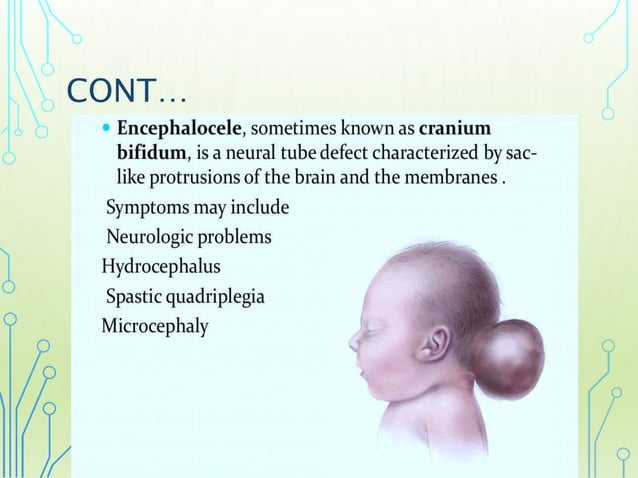 Neural tube defect | PPTX | Pregnancy | Reproductive Health