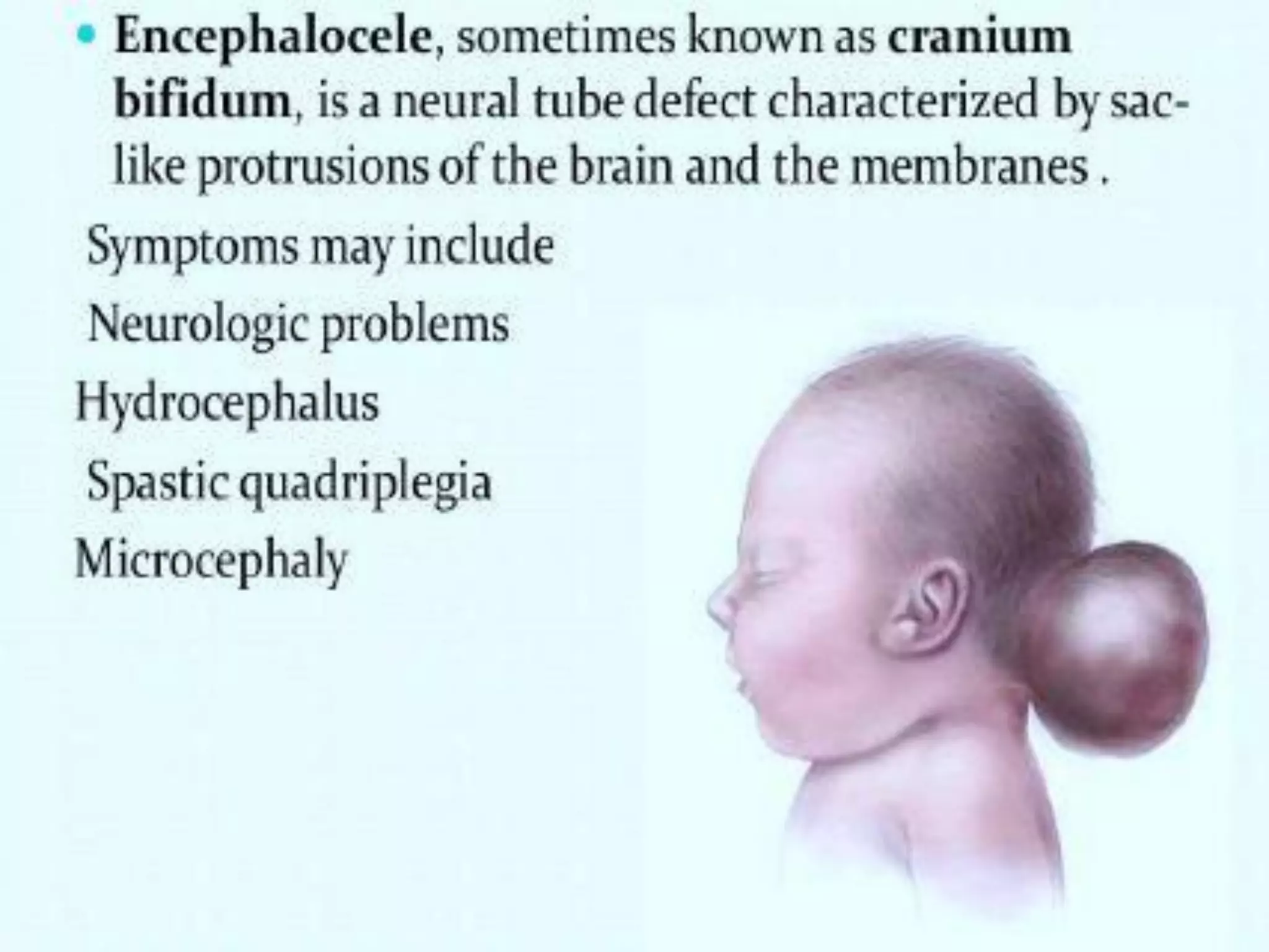 Neural tube Defect & Hydrocephalus | PDF