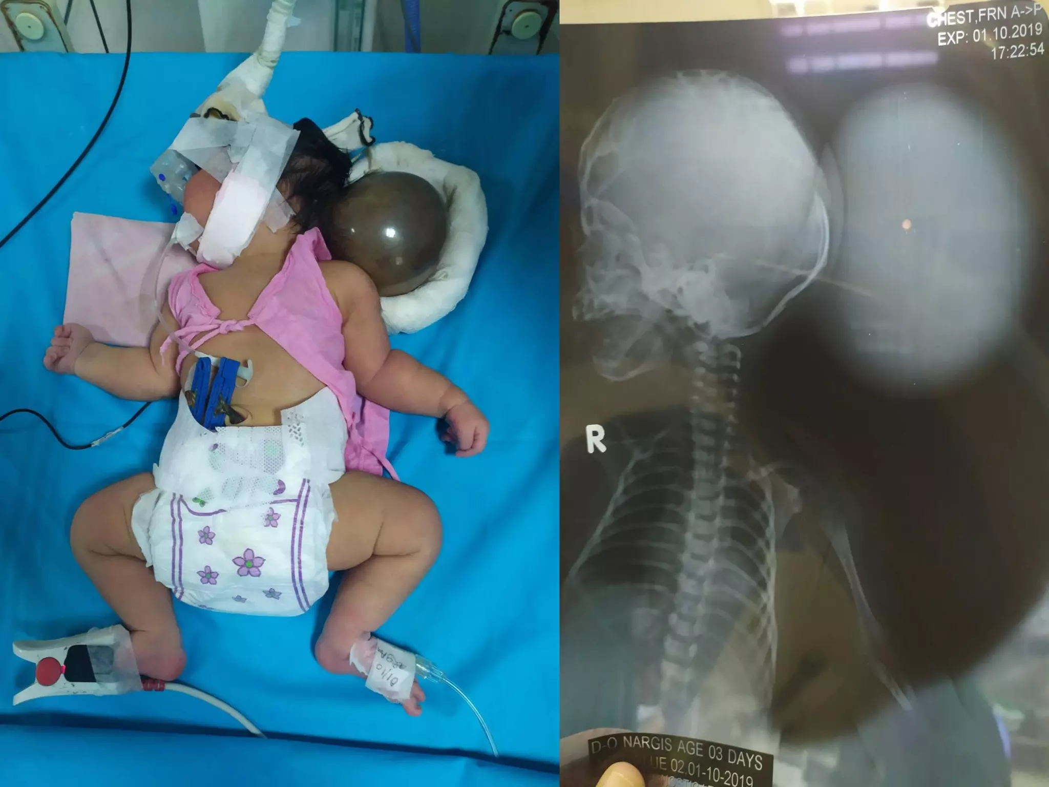 Neural tube Defect & Hydrocephalus | PDF