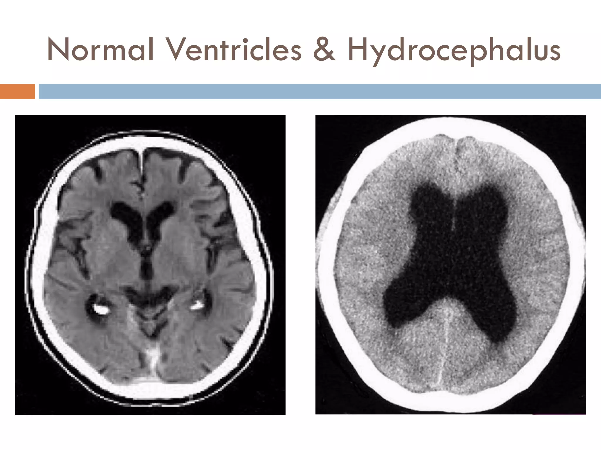 Neural tube Defect & Hydrocephalus | PDF