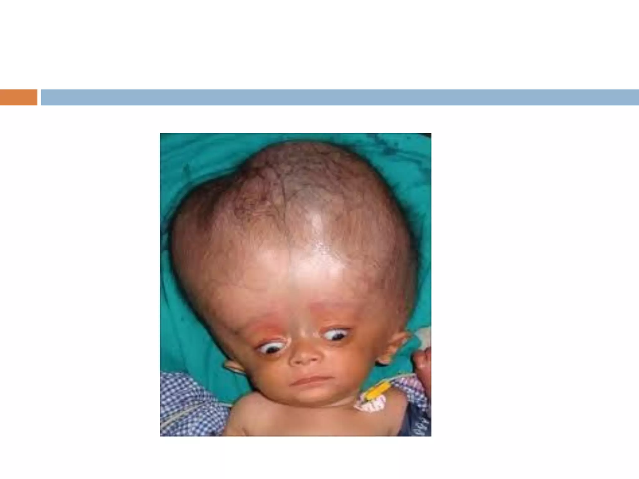 Neural tube Defect & Hydrocephalus | PDF