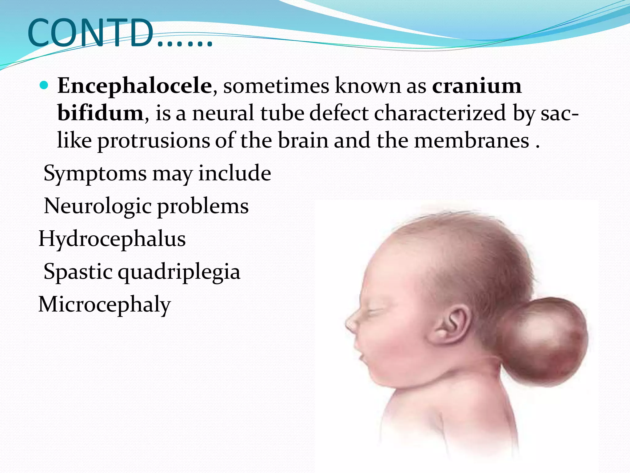 Neural tube defect presentation | PPTX