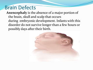Neural tube defect presentation | PPTX
