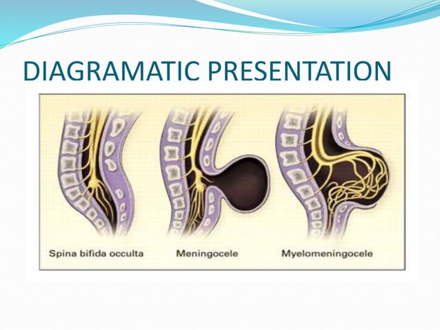 Neural tube defect presentation