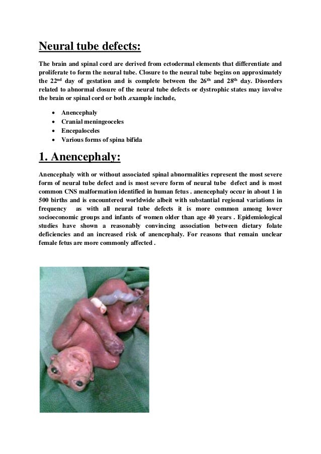 Neural tube defects