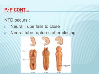 Neural tube defects | PPTX