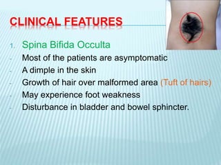 Neural tube defects | PPTX