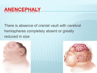 Neural tube defects | PPTX