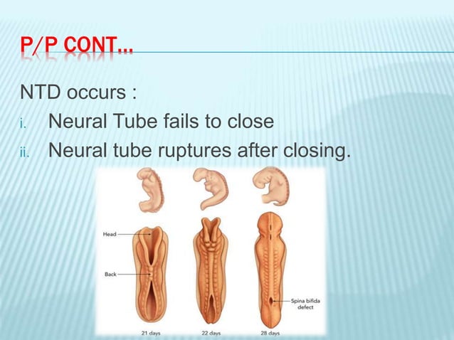 Neural tube defects