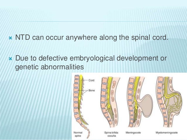 Neural tube defects