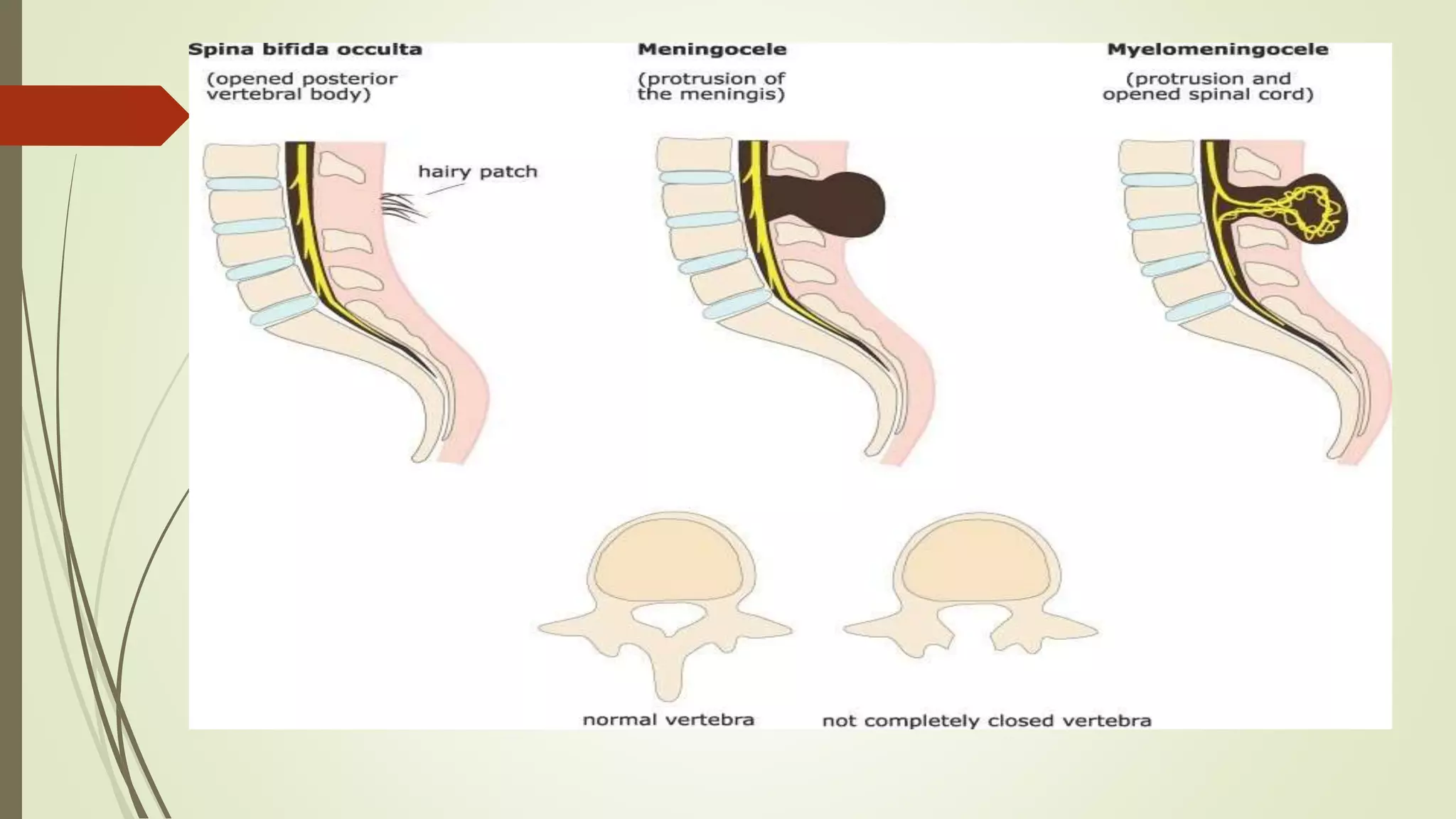 Neural tube defects | PPTX