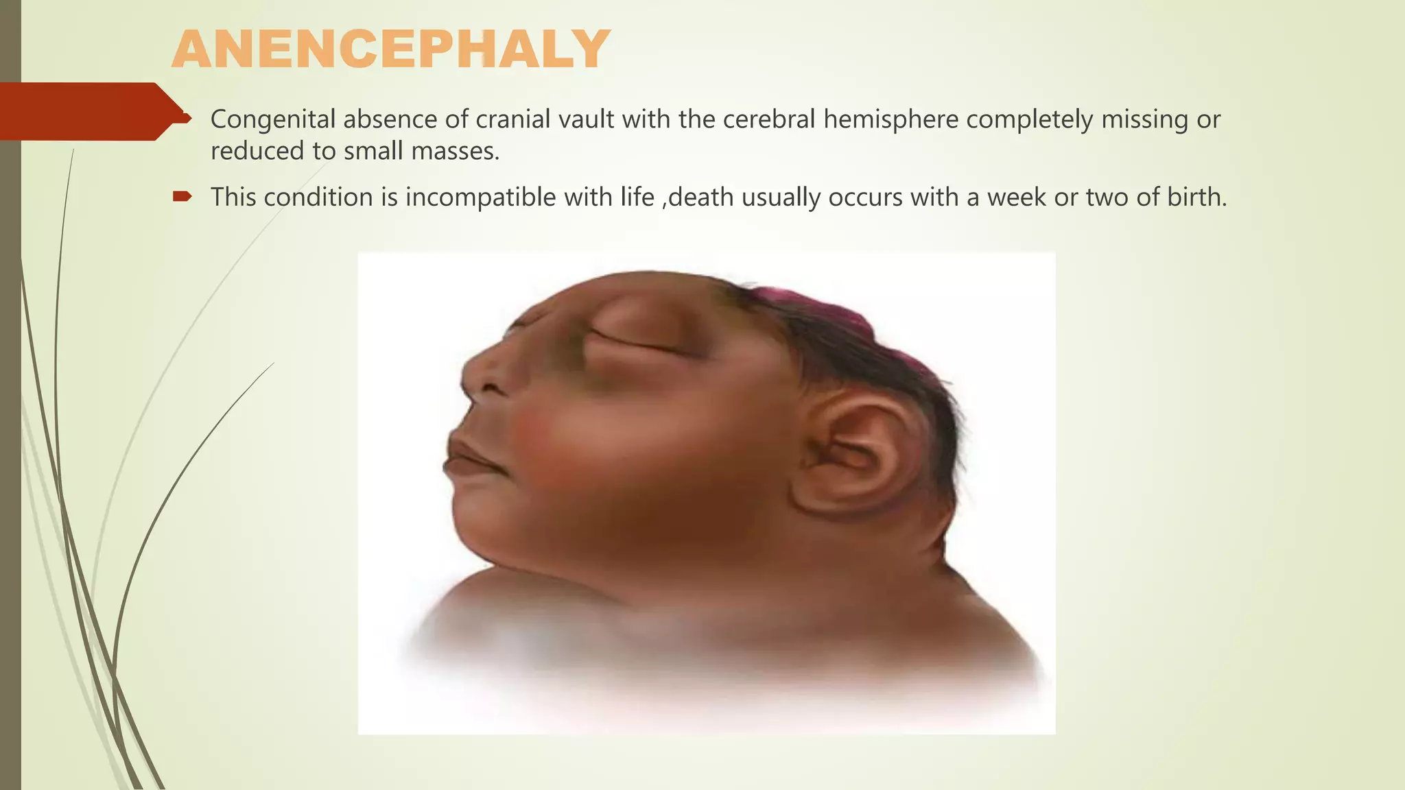 Neural Tube Defects Ppt