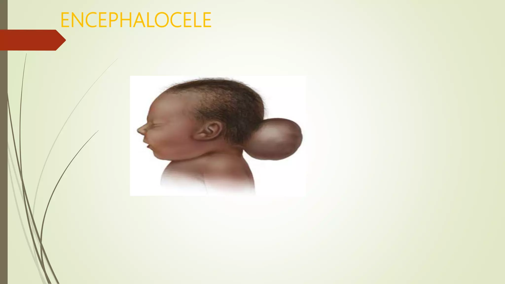 Neural tube defects | PPTX
