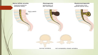 Neural tube defects | PPTX | Pregnancy | Reproductive Health