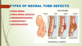Neural tube defects | PPTX