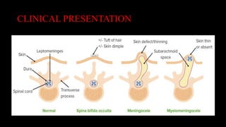 NEURAL TUBE DEFECTs.pptx