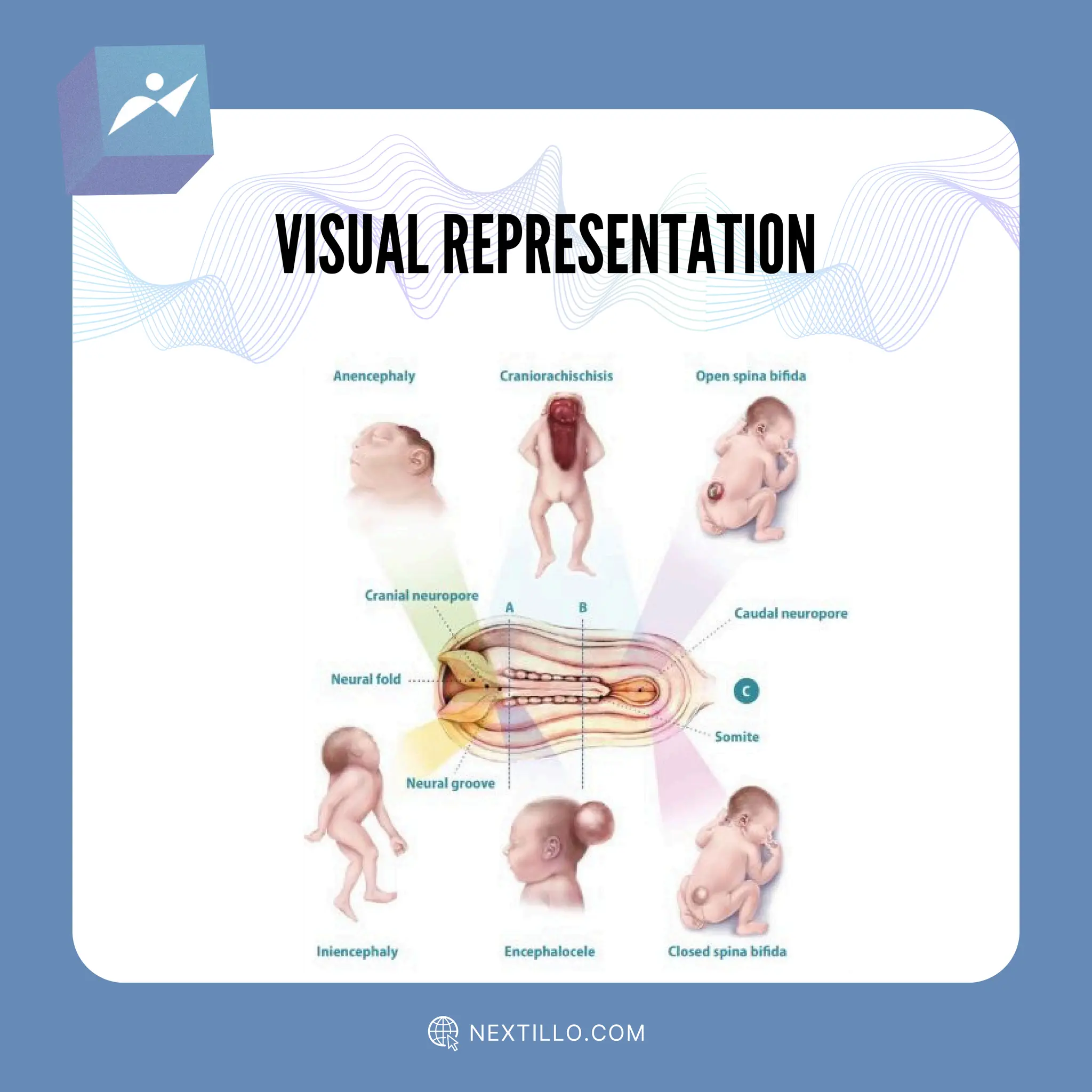 Neural Tube Defects | DIBS | Nextillo India | PDF