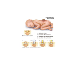 Neural tube defects (also known as spina bifida or myelodysplasia) | PPT