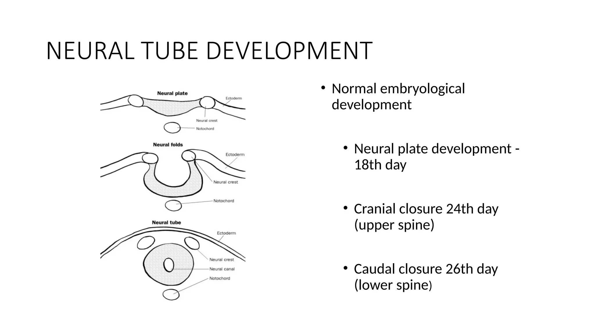 Neural Tube Defects in children - paediatric surgery | PPT