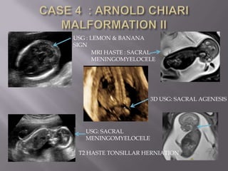 Neural tube defects a case series - copy | PPTX