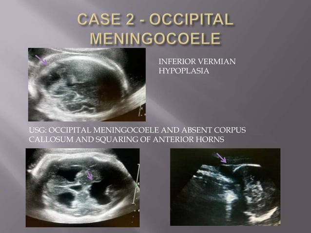 Neural Tube Defects Ntd Medchrome