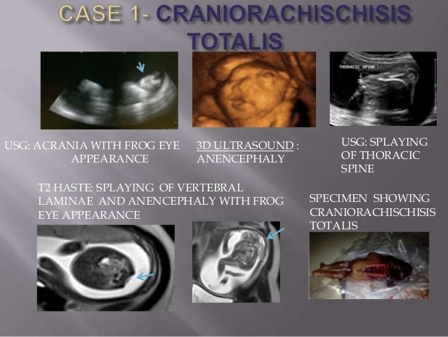 Neural tube defects a case series - copy