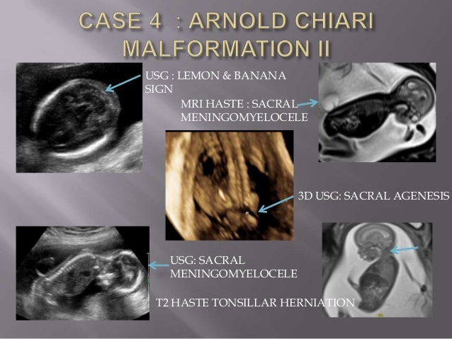 Neural tube defects a case series - copy