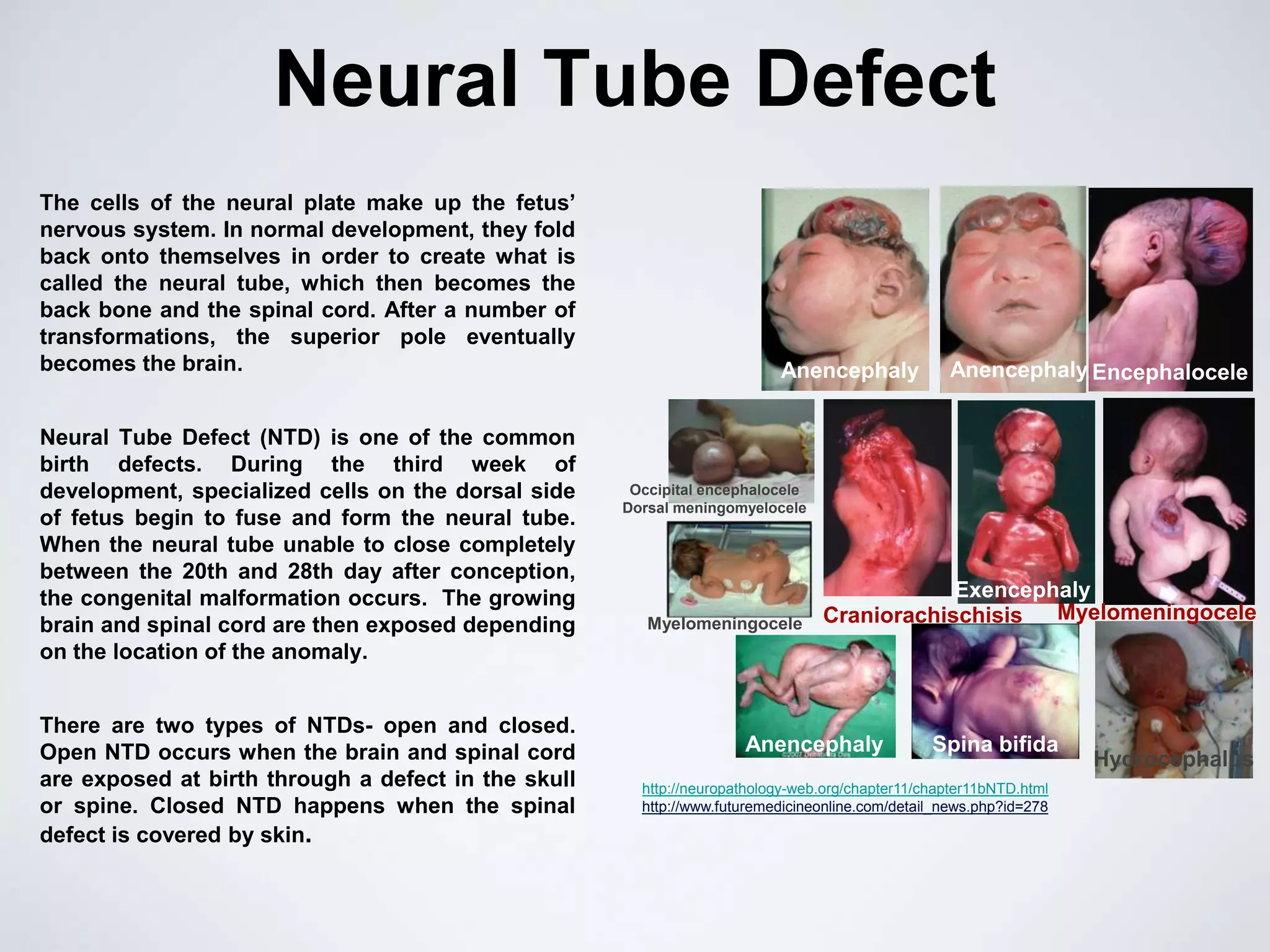Neural tube defects: Importance of Folic Acid and Vitamin B12 intake | PPSX
