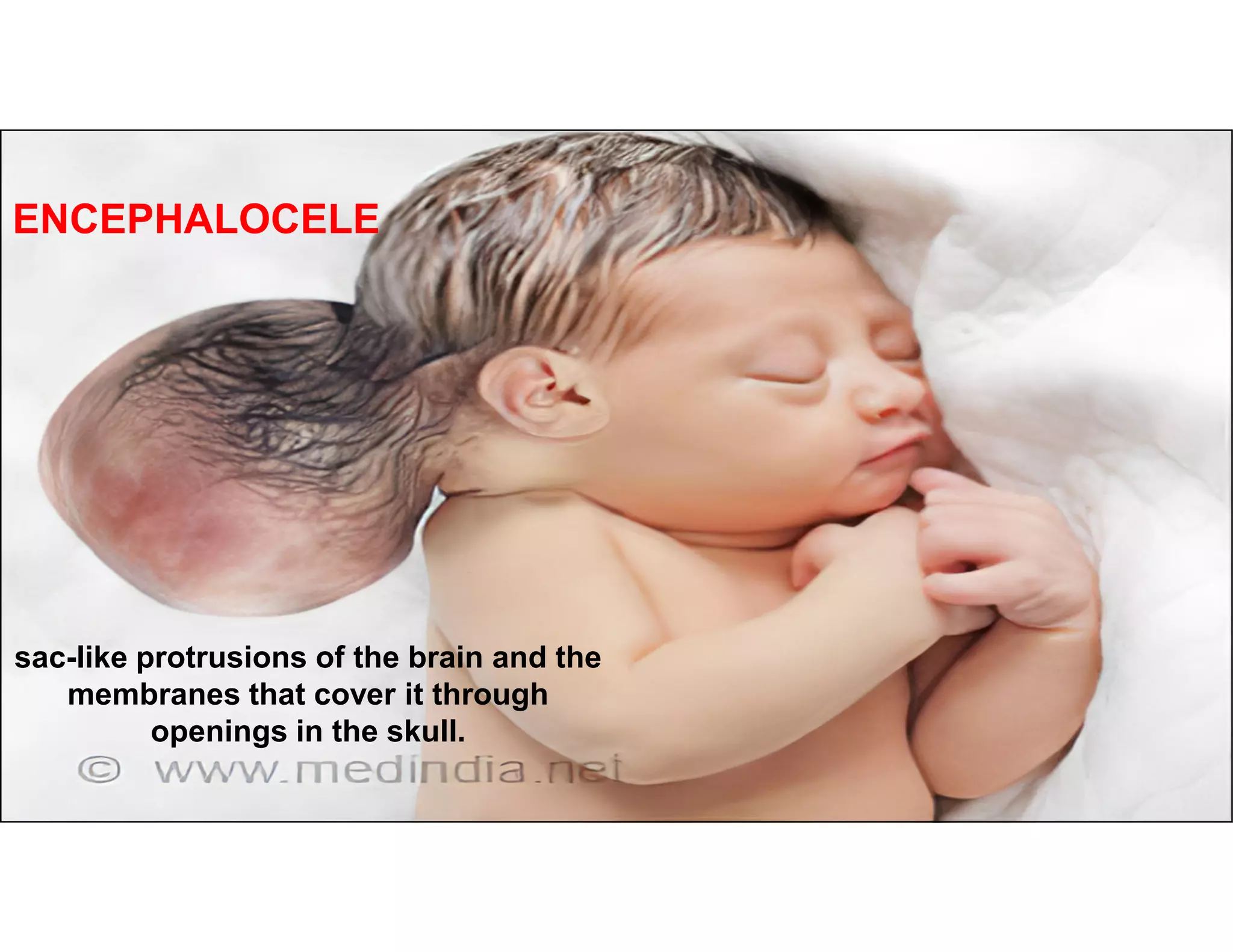 Neural tube defects and the role of folic acid in Lowering the Risk.pdf