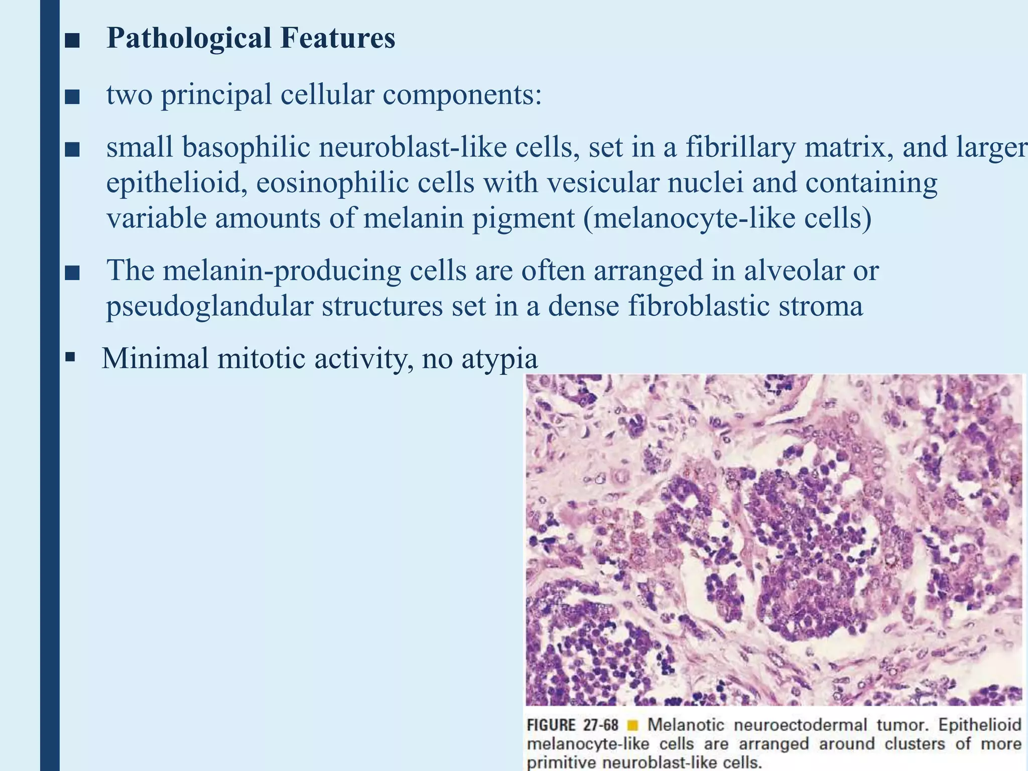 Neural tumors | PPTX