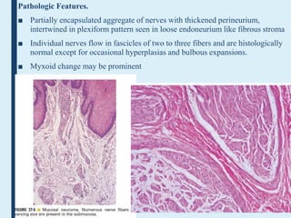 Mucosal Neuroma Histology